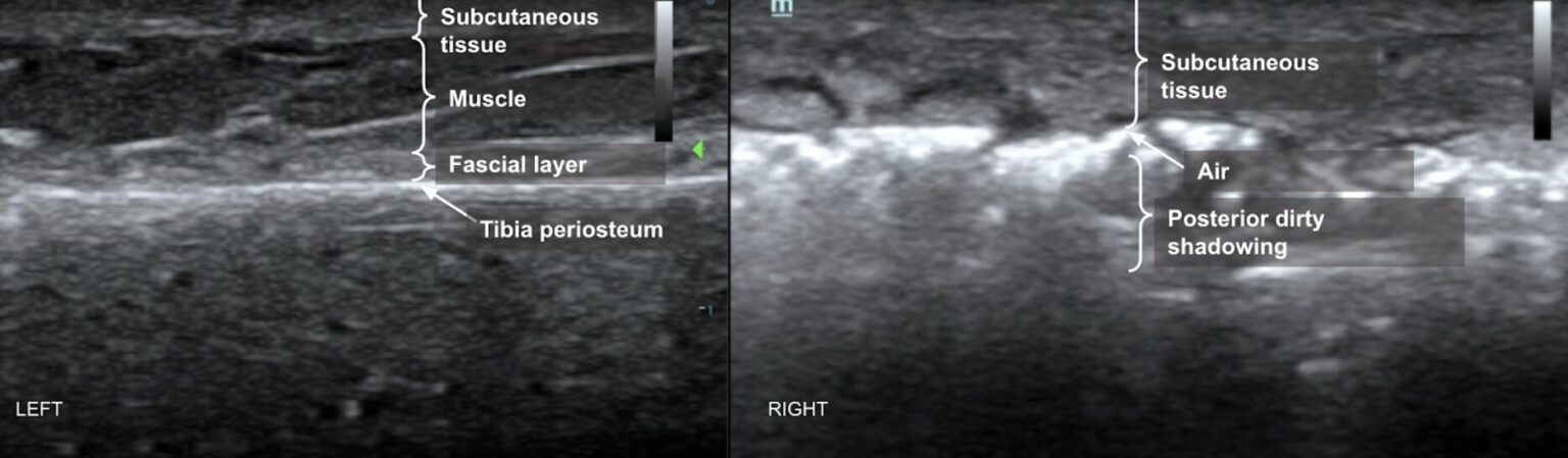 POCUS Diagnosis of NSTI - emDocs
