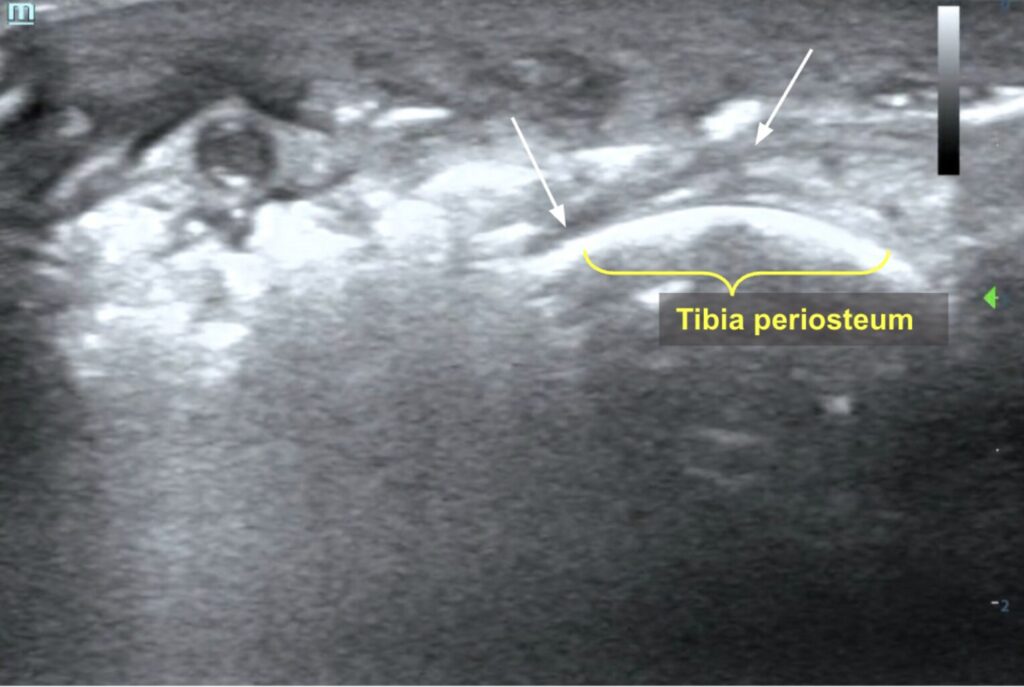 POCUS Diagnosis of NSTI - emDocs