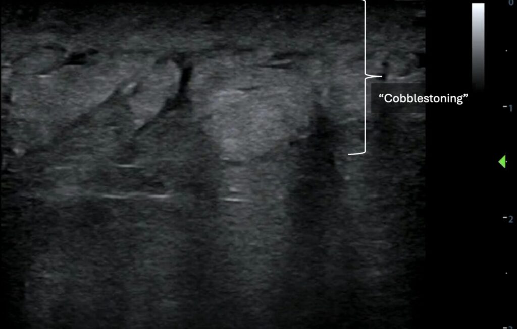 POCUS Diagnosis of NSTI - emDocs