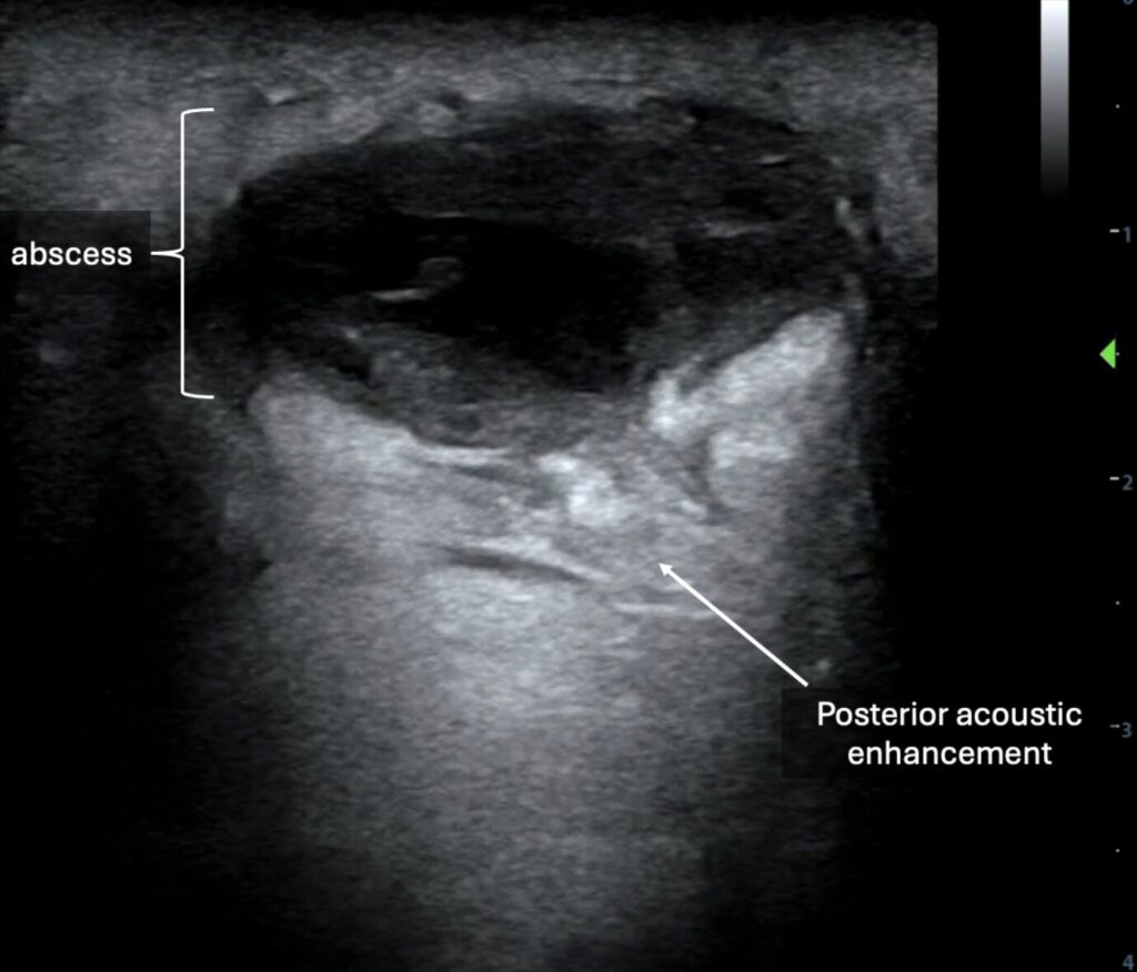 POCUS Diagnosis of NSTI - emDocs