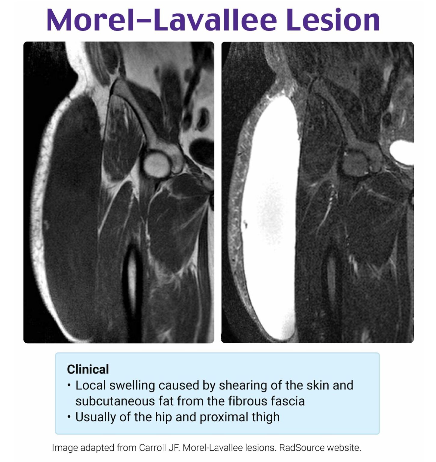 EM@3AM: Morel-Lavallée Lesion - emDocs