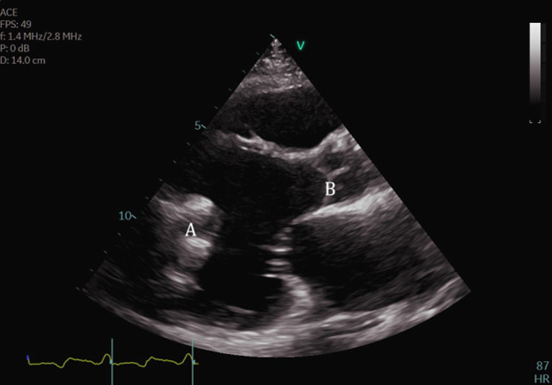 Update on LVADs in the ED: Presentations, Evaluation, and Management ...