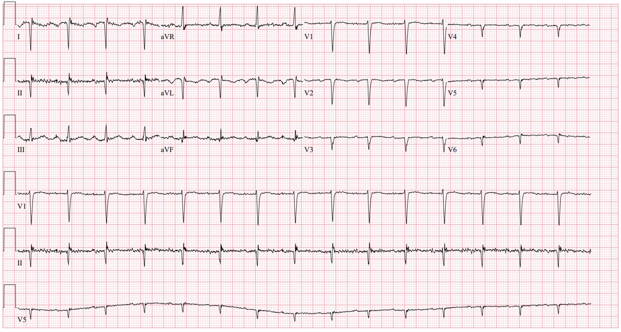 ECG Pointers: Mrs. Robinson Strikes Again... - emDocs